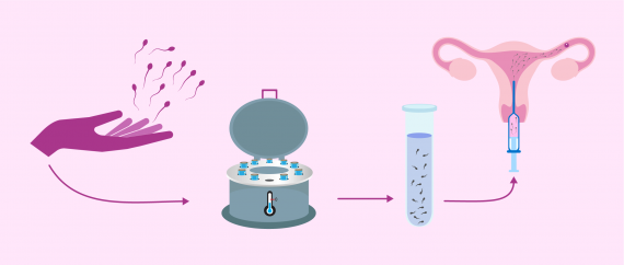 The IUI Procedure: What I Learned After One Summer Fling - Making ...